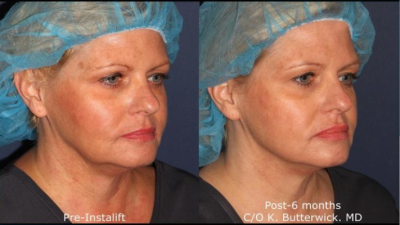 Cosmetic Surgery Alternatives - Transformative Medical Spa in ...