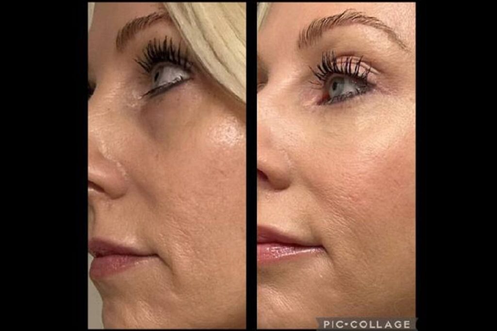 SKINVIVE by Juvéderm in Scottsdale, AZ | Ultra Smooth Skin