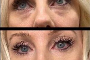 SKINVIVE by Juvéderm in Scottsdale, AZ | Ultra Smooth Skin